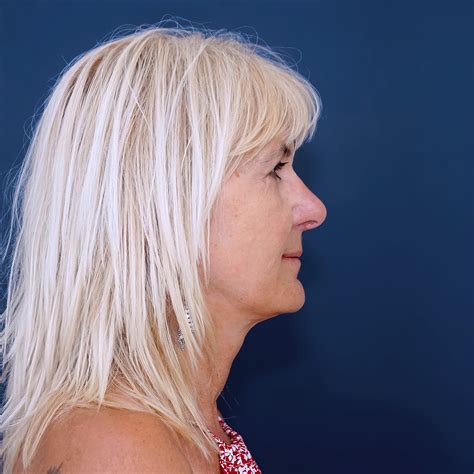 Galerie Proměn Operace Víček Klinika Esthé Praha