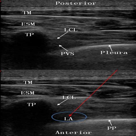 Ultrasound Image Of The Thoracic Paravertebral Block The Red Arrow