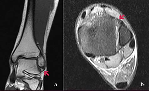 Anterior Tibiofibular Ligament Mri
