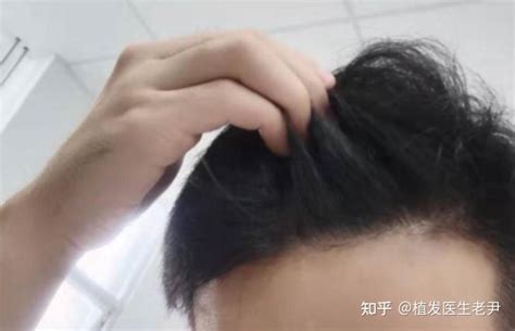 植发1000单位效果图
