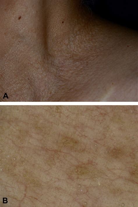Dermoscopy Of Pseudoxanthoma Elasticum Like Papillary Dermal Elastolysis Journal Of The