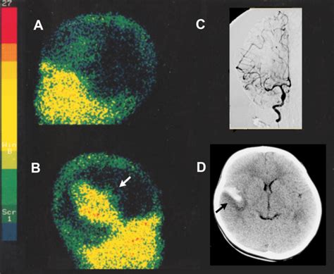 Herpes Simplex Encephalitis Involving The Right Temporal Lobe A And B