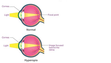 Hypermetropia Causes Symptoms And Treatments Laxmi Eye Hospital