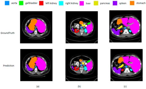 Shifttransunet An Efficient Deep Learning Model For Medical Image