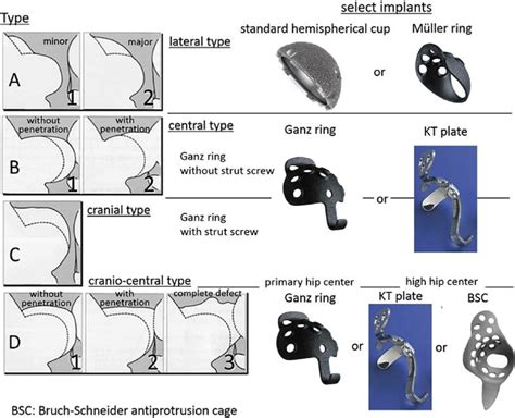 We Classified The Preoperative Acetabular Bone Deficiency Using X Ray Download Scientific
