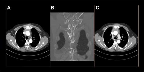 Preoperative Thoracic Ct Scan A Image Indicates The Sternal Defect