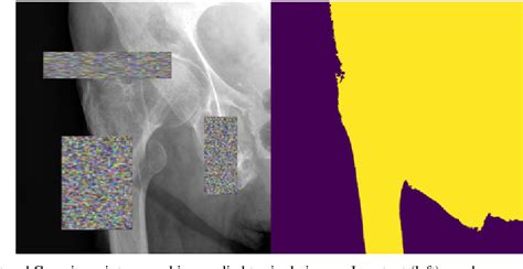 Automatic Hip Fracture Identification And Functional Subclassification With Deep Learning