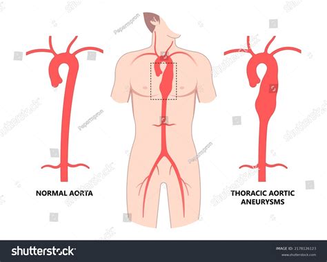 Heart Aorta Attack Aortic Arch Bulge Stock Vector Royalty Free 2178126123 Shutterstock