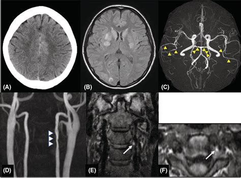 Neuroradiological Findings At Onset A Plain Ct Scan Revealed Hyper