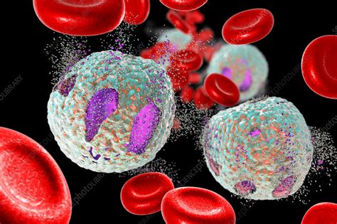 Acute Lymphoblastic Leukaemia Treatment Illustration Stock Image
