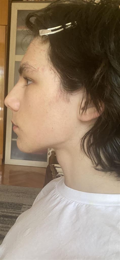 Will Getting A Palate Expander My Palate Is Already Narrow Push My