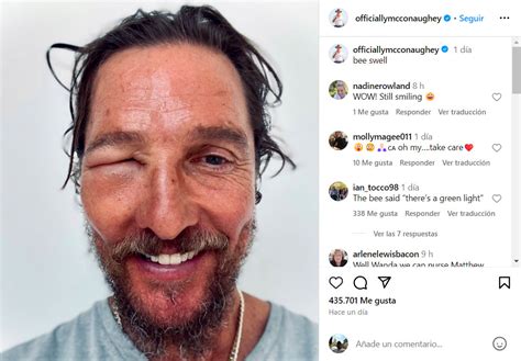 Matthew Mcconaughey Queda Desfigurado Tras Sufrir Picadura De Abeja En