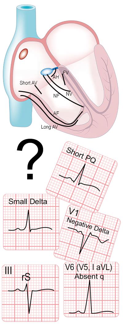 Atypical Pathways And Sinus Rhythm Ecg