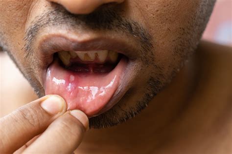 Canker Sore Under Tongue Web