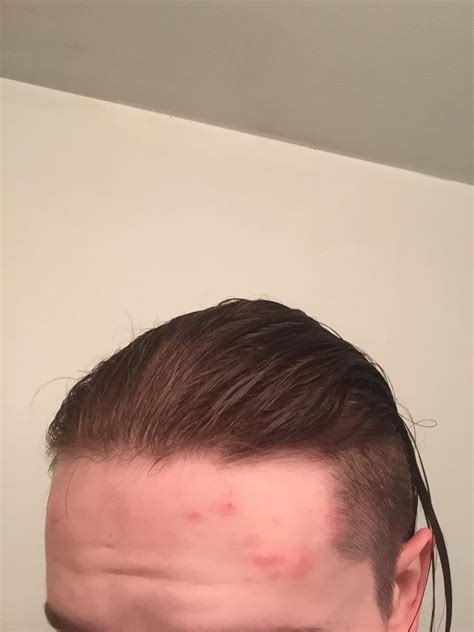 I Have A Small Bed Bug Problem R Wtf