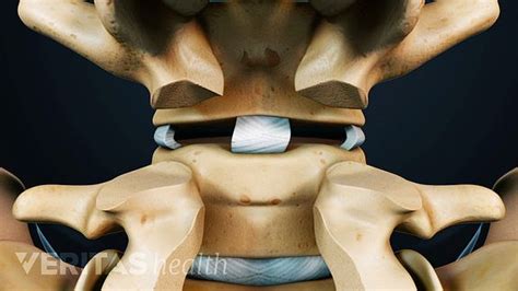 A Visual Guide To Posterior Lumbar Interbody Fusion Plif