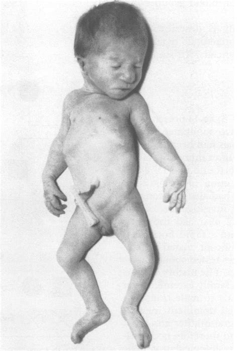 The Distinct Facial Dysmorphism Download Scientific Diagram