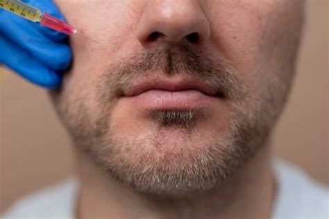Amlodipine Lip Swelling