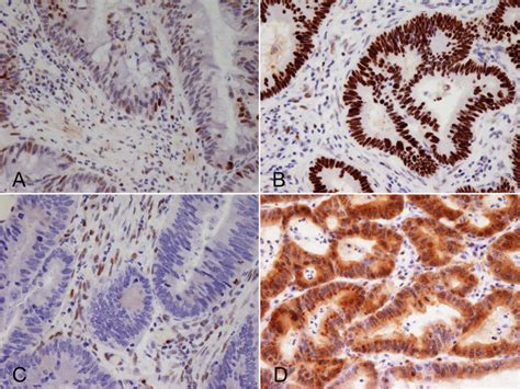The Pattern Based Interpretation Of P53 Immunohistochemical Expression As A Surrogate Marker For