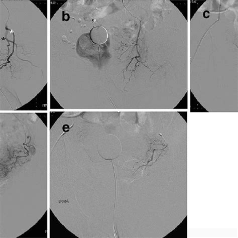 Pdf Prostatic Artery Embolization In Benign Prostatic Hyperplasia Preliminary Results In 13
