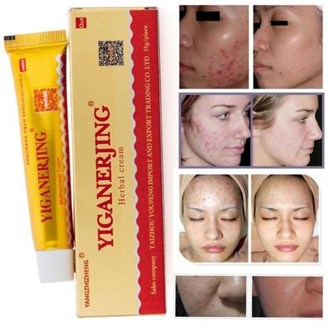 Jual Salep Yiganerjing Cream Yiganerjing 15gram Salep Eksim Jamur