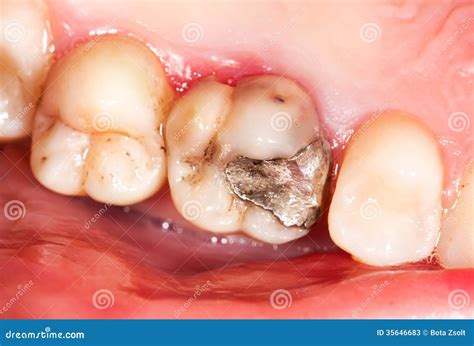 Amalgam Filling Stock Image Image Of Human Plaque Care 35646683