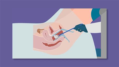 Acog Explains Cervical Cancer Screening Jessica L