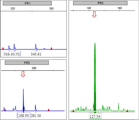 Clonal Rearrangement Of The Immunoglobulin Heavy Chain Gene Locus Igh