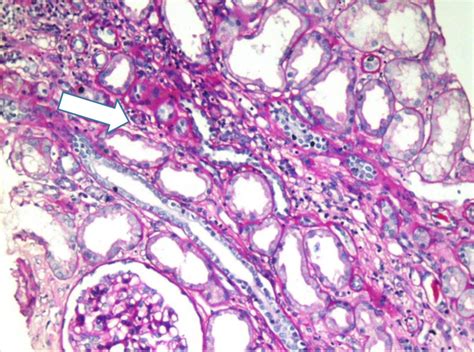 Morphological Features Suggestive Of Calcineurin Inhibitor Cni