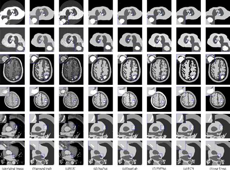 Figure 1 From Superpixel Region Merging Based On Deep Network For Medical Image Segmentation
