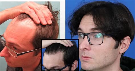 Hair Transplant Before And After Photos Celebrity Men And Women