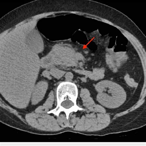Vertical Cross Section Ct Imaging Of The Abdomen With The Arrow