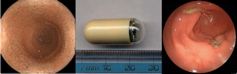 Anomaly Detection In Capsule Endoscopy Images An Insight By