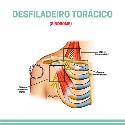 SÍNDROME DO DESFILADEIRO TORÁCICO Ortopedia
