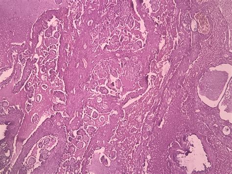 Clear Cell Carcinoma Ovary Histopathologyguru