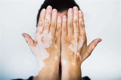 7 Benefits Of Using Monobenzone Skin Cream For Vitiligo Treatment