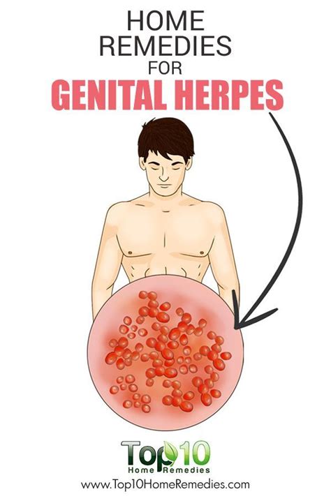 Home Remedies For Genital Herpes Artofit
