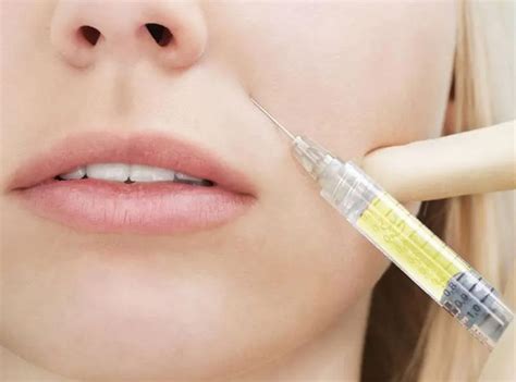 Bio Filler With Plasma Gel • Junglinster Luxembourg • Advance Aesthetics