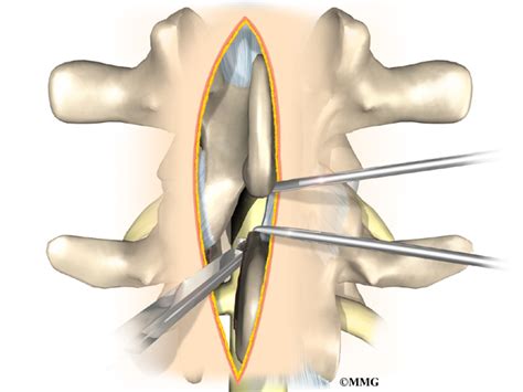 Posterior Lumbar Fusion