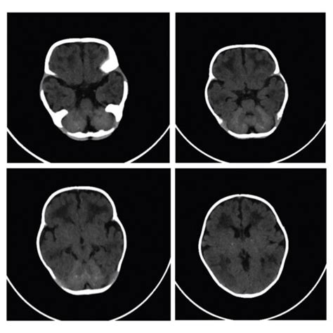 Brain Ct Scan Diffuse Calcifications Involving Both Lobes As Well As