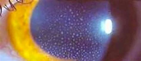 Uveitis Services In New Delhi Id 2852109555533