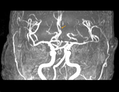 Corpus Callosum Infarction Mri Sumers Radiology Blog