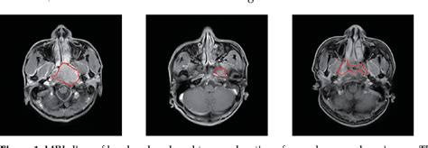 figure 1 from lightweight compound scaling network for nasopharyngeal