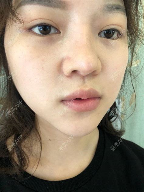 厚唇改薄整形图片整形m唇图片大山谷图库