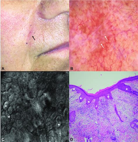 What Is Nodular And Micronodular Basal Cell Carcinoma