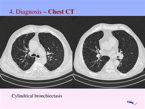Ppt Clinical Manifestation And Diagnosis Of Bronchiectasis Aleš