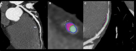 Frontiers Quantitative And Qualitative Features Of Carotid And