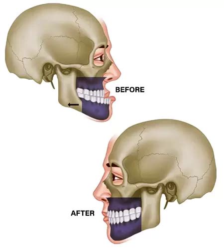 Overbite Surgery Procedure