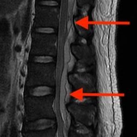Spinal Epidural Abscess Radiology