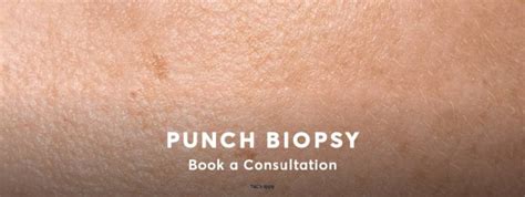 Punch Biopsy Pulse Light Clinic London Book Consultation
